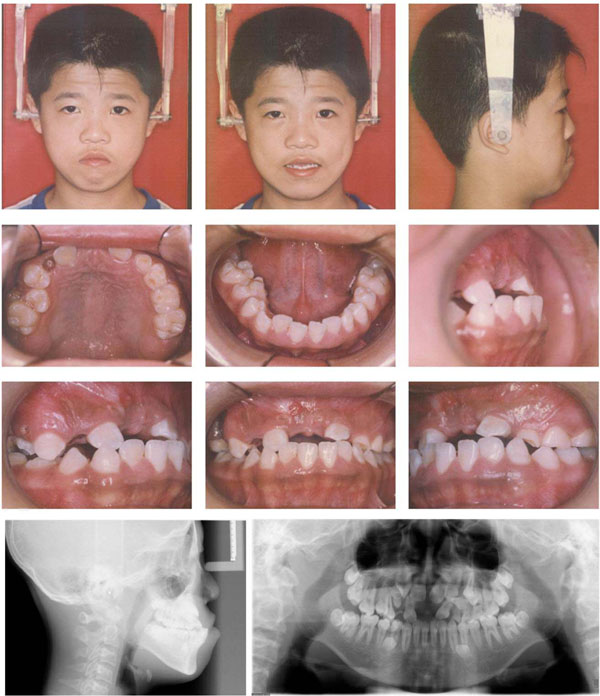 Combined Orthodontic-surgical Treatment for Skeletal Class III ...